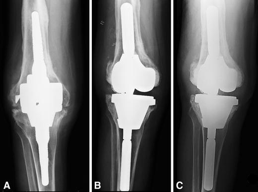 Tantalum Cones Provide Durable Mid-term Fixation in Revision TKA ...