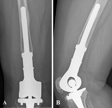 What Are the Long-term Results of MUTARS® Modular Endoprostheses for ...