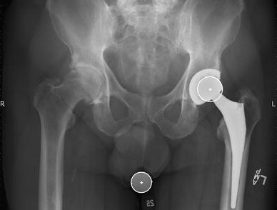 Inaccuracies in the Use of Magnification Markers in Digital Hip ...