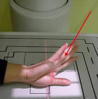 Classifications in Brief: The Eaton-Littler Classification of Thumb ...