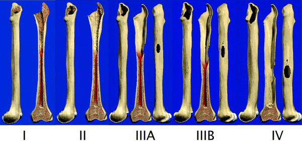 Classifications In Brief: The Paprosky Classification of Femoral Bone ...