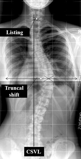 Preventing Fusion Mass Shift Avoids Postoperative Distal Curve Adding ...