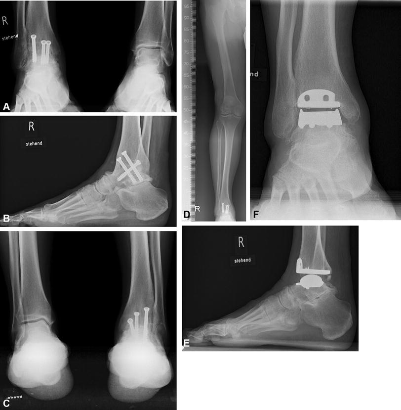 Can a Three-Component Prosthesis be Used for Conversion of Painful ...