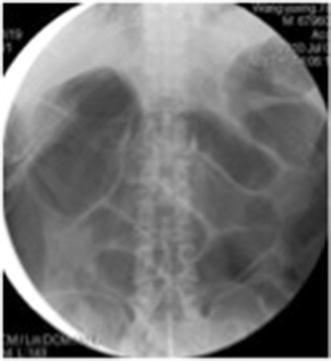Treatment of Intestinal Paralysis Using Revised Major Purgative ...