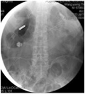 Treatment of Intestinal Paralysis Using Revised Major Purgative ...