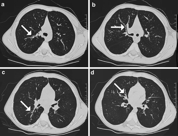 A Review of Non-Cystic Fibrosis Pediatric Bronchiectasis | SpringerLink
