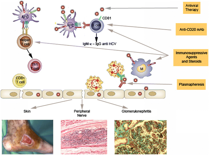 Hepatitis C Virus Infection Induced Vasculitis | SpringerLink