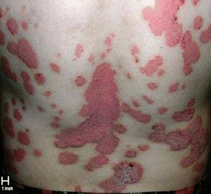Clinical and Histologic Diagnostic Guidelines for Psoriasis: A Critical ...