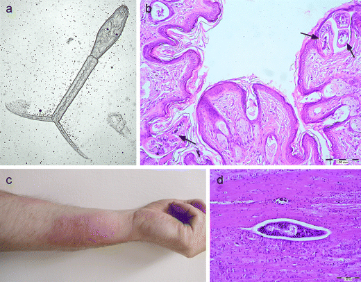 Cercarial Dermatitis, a Neglected Allergic Disease | SpringerLink
