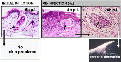 Cercarial Dermatitis, a Neglected Allergic Disease | SpringerLink