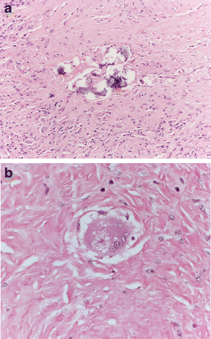 Pathology of Sarcoidosis | SpringerLink