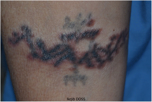 Medical Complications of Tattoos: A Comprehensive Review | SpringerLink