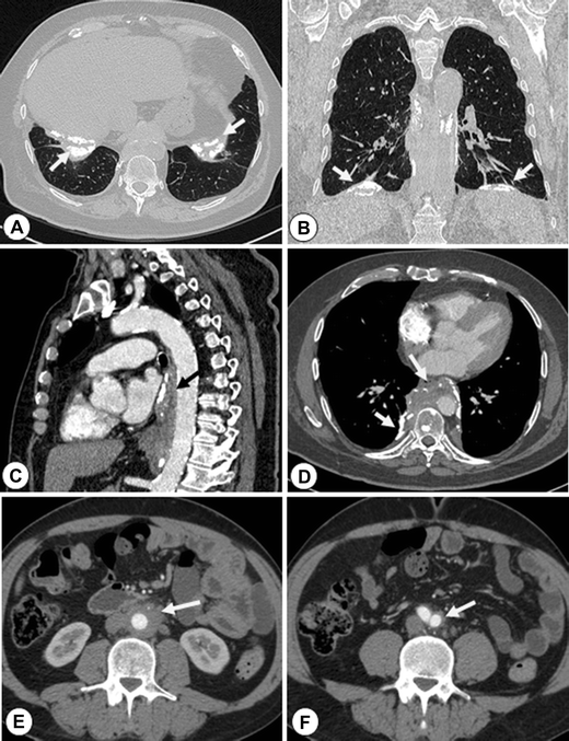 Idiopathic Mediastinal Fibrosis: a Systemic Immune-Mediated Disorder. A ...