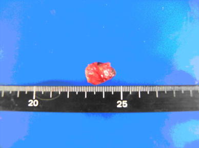 VIPoma with expression of both VIP and VPAC1 receptors in a patient ...