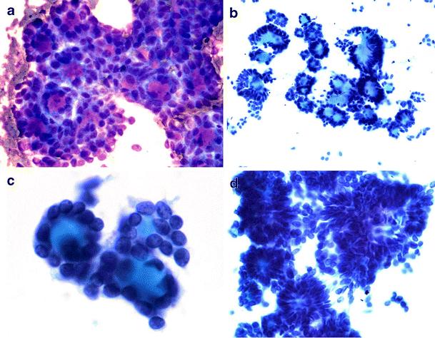 Unique Growth Pattern in Papillary Carcinoma of the Thyroid Gland ...