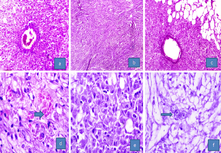 Malignant Perivascular Epithelioid Cell Tumor (PEComa) of the Adrenal ...