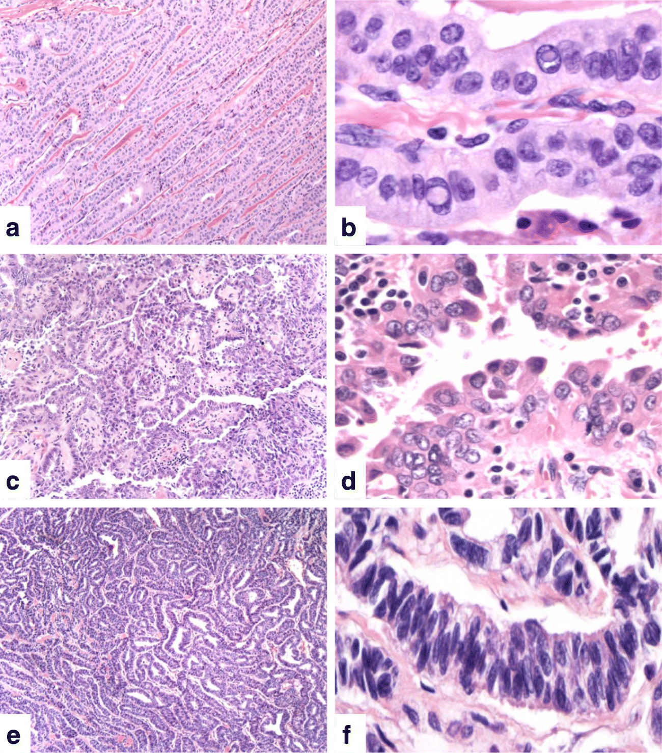 Clinically Relevant Prognostic Parameters in Differentiated Thyroid ...