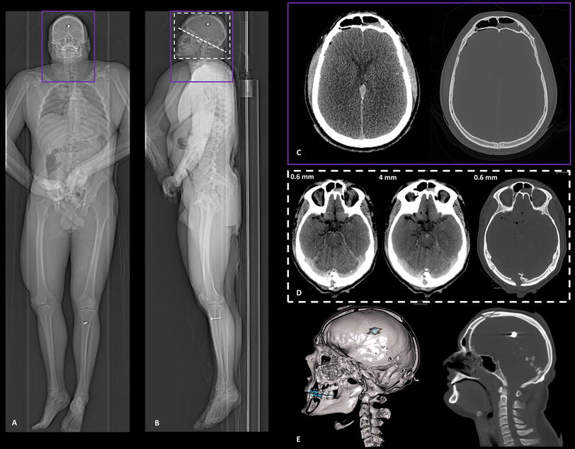 Imaging in forensic radiology: an illustrated guide for postmortem ...