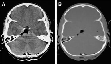 Pneumocephalus: Case Illustrations and Review | SpringerLink