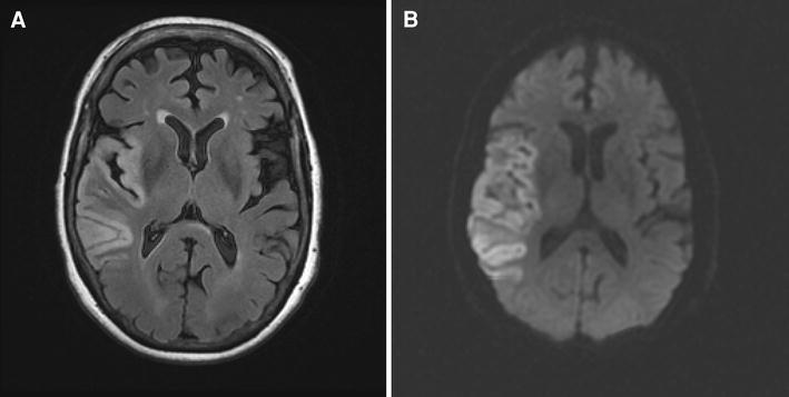 Angioedema After tPA: What Neurointensivists Should Know | SpringerLink