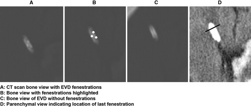 Safety of Intraventricular Hemorrhage (IVH) Thrombolysis Based on CT ...