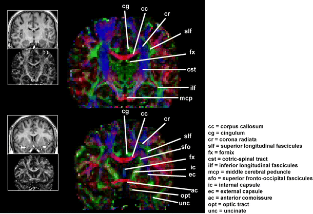 Diffusion Tensor Imaging (DTI)-based White Matter Mapping in Brain ...