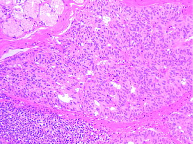 Endoscopic mucosa resection of a duodenum carcinoid tumor of 1.2 cm ...