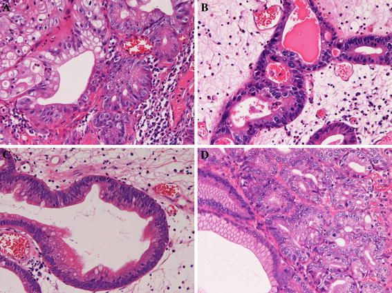Malignant transformation of foveolar hyperplastic polyp of the stomach ...