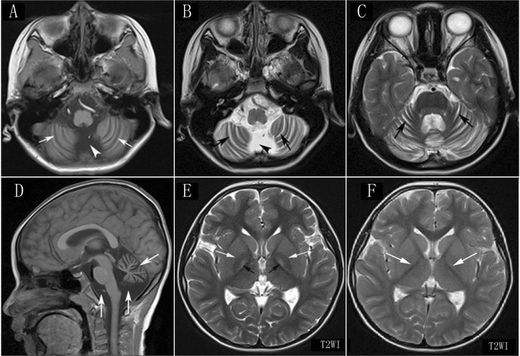 Identification of Novel Compound Mutations in PLA2G6-Associated ...