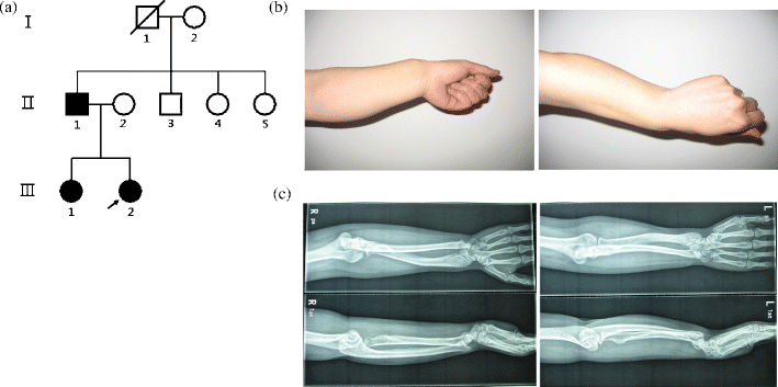 Identification of a novel SHOX mutation in a Chinese family with ...