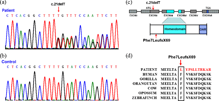 Identification of a novel SHOX mutation in a Chinese family with ...