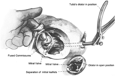 Closed mitral commissurotomy for mitral stenosis with dextrocardia—case ...