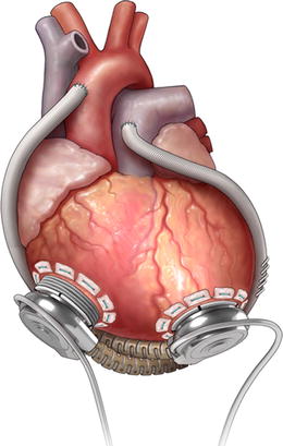 Mechanical support for biventricular failure using the HeartWare (HVAD ...