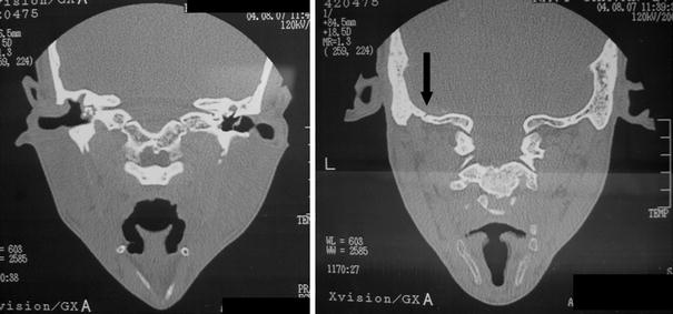 Combined Middle Cranial Fossa and Trans-Mastoid Approach for the ...
