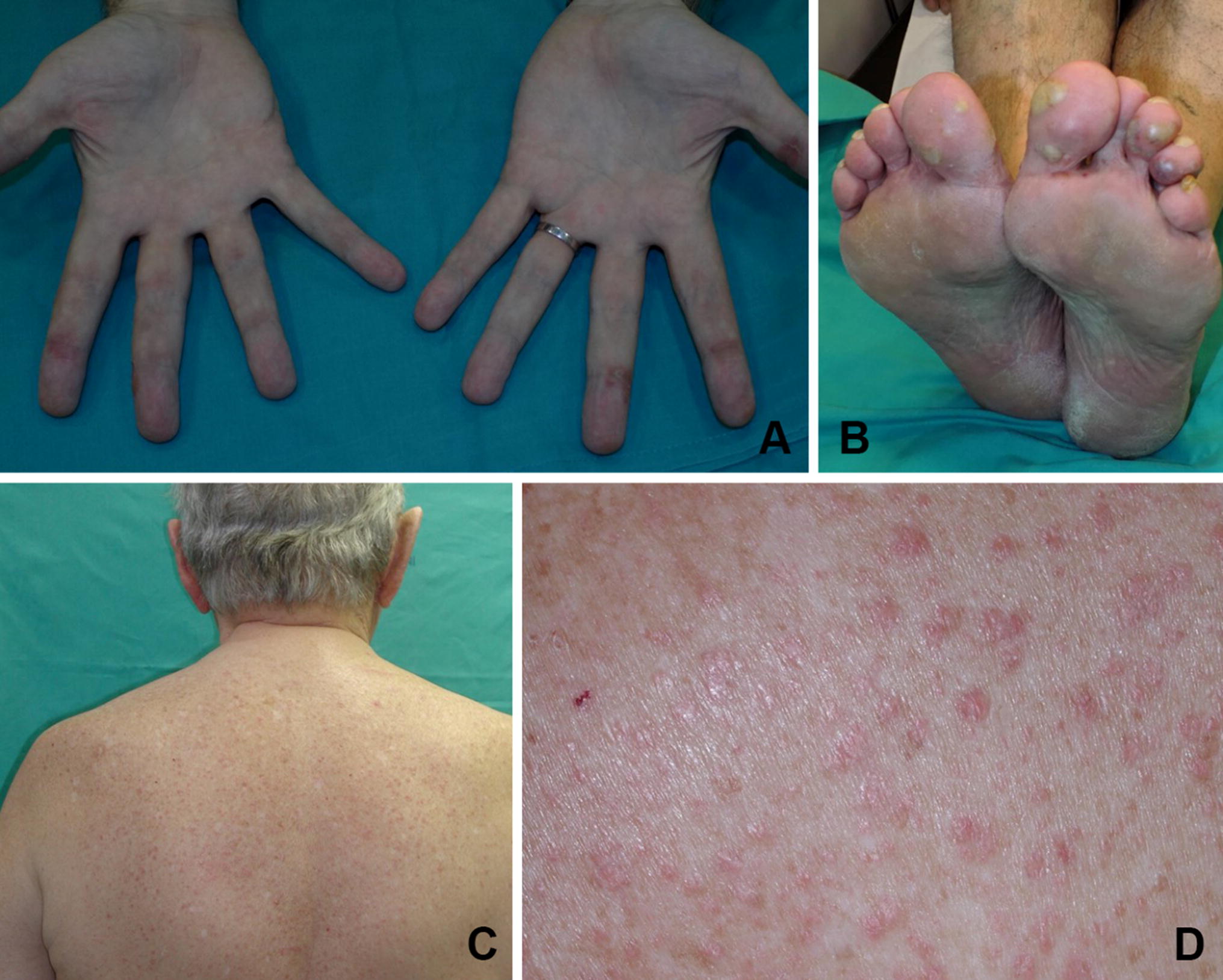 Clinical management of cutaneous adverse events in patients on targeted ...