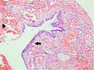 Ependymal Brain Cyst with Posterior Cerebral Artery Infarct | SpringerLink