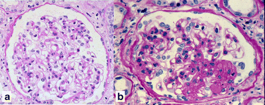 Nephrotic Syndrome | SpringerLink