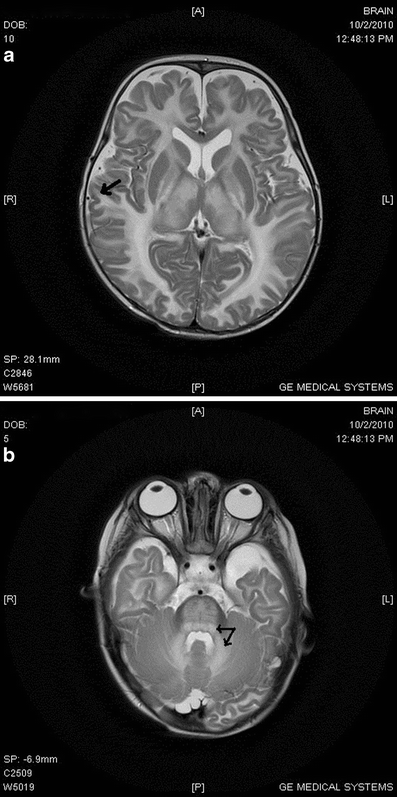 Radiological Clue to Diagnosis of Canavan Disease | SpringerLink