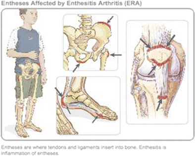 Approach to Joint Pain in Children | SpringerLink