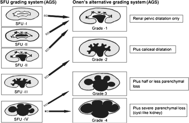 Is it Always Necessary to Treat an Asymptomatic Hydronephrosis Due to ...