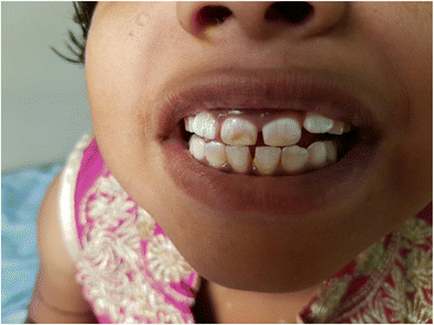 Curse of Fluorosis | SpringerLink