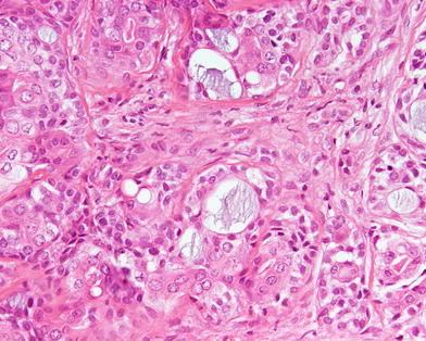 Ceruminous Gland Carcinomas: A Clinicopathologic and Immunophenotypic ...