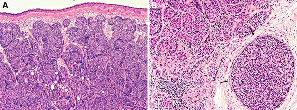 Malignant Cylindroma of the Scalp Arising in a Setting of Multiple ...