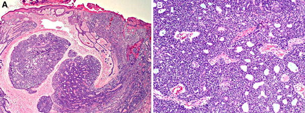Malignant Cylindroma of the Scalp Arising in a Setting of Multiple ...