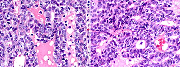 Malignant Cylindroma of the Scalp Arising in a Setting of Multiple ...