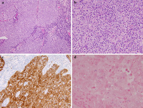 HPV-Related Squamous Cell Carcinoma Variants in the Head and Neck ...