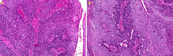 Papillary Variant of Squamous Cell Carcinoma Arising on the Gingiva: 61 ...