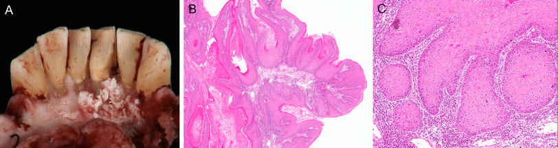 Verrucous Carcinoma with Dysplasia or Minimal Invasion: A Variant of ...