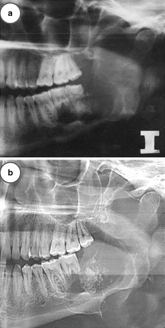 Odontogenic Carcinoma with Dentinoid: A New Odontogenic Carcinoma ...