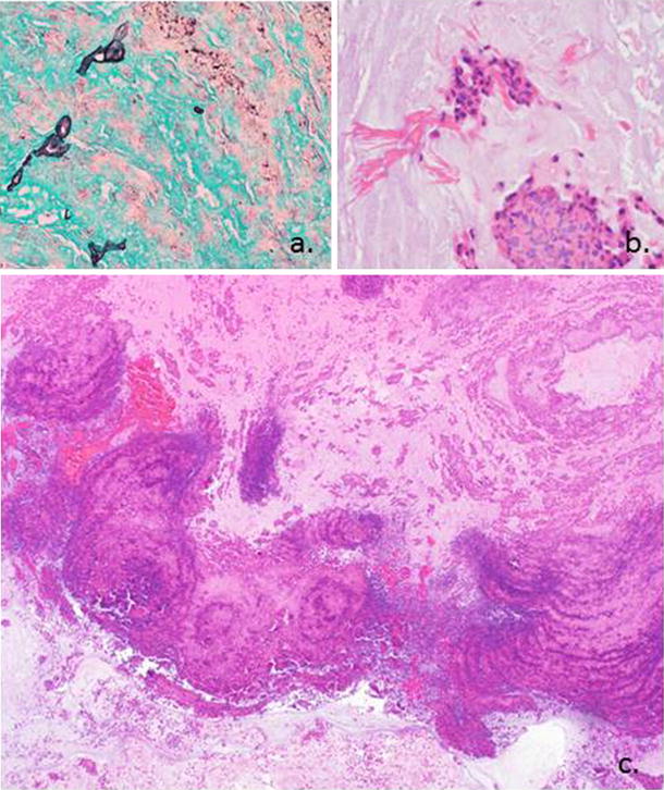 Allergic Fungal Sinusitis | SpringerLink